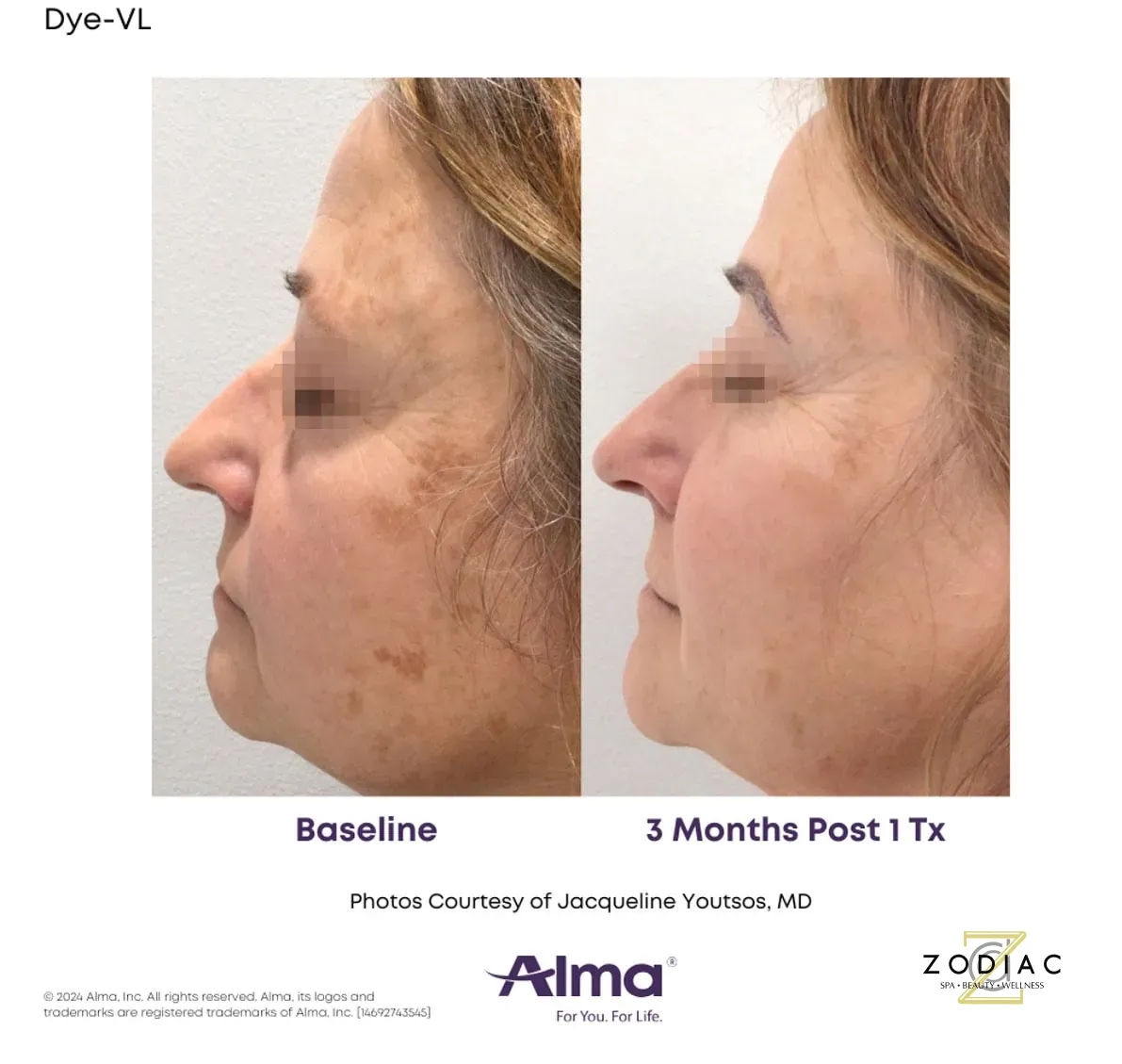 Aesthetic Treatments Before & After Images In Herriman, UT