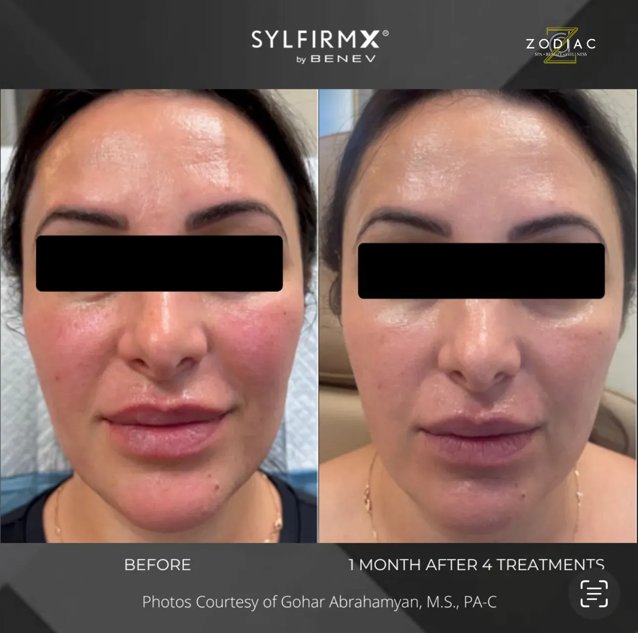 Aesthetic Treatments Before & After Images In Herriman, UT