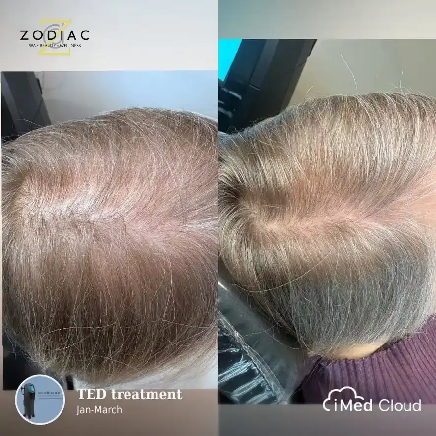 Aesthetic Treatments Before & After Images In Herriman, UT