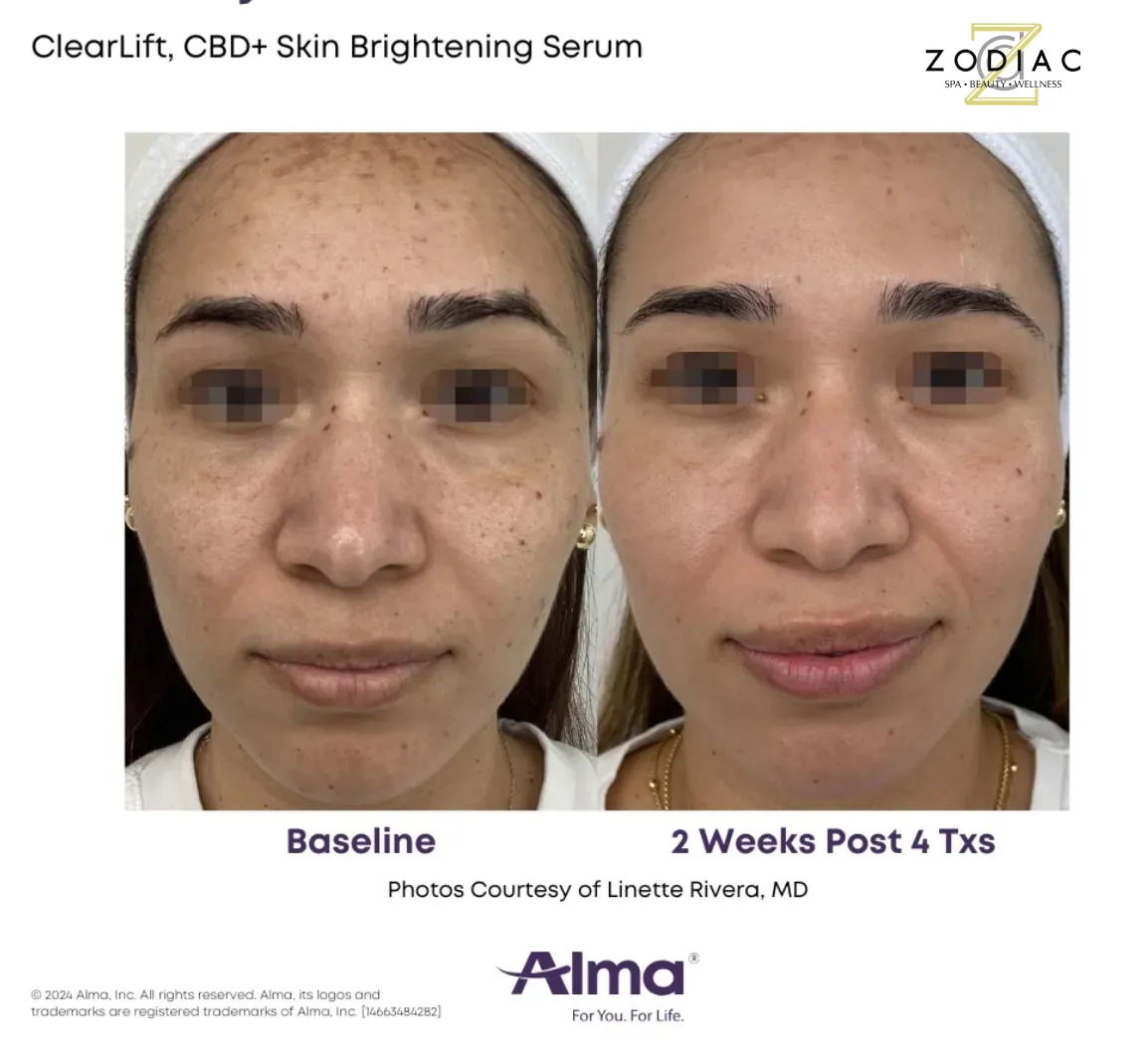 Aesthetic Treatments Before & After Images In Herriman, UT